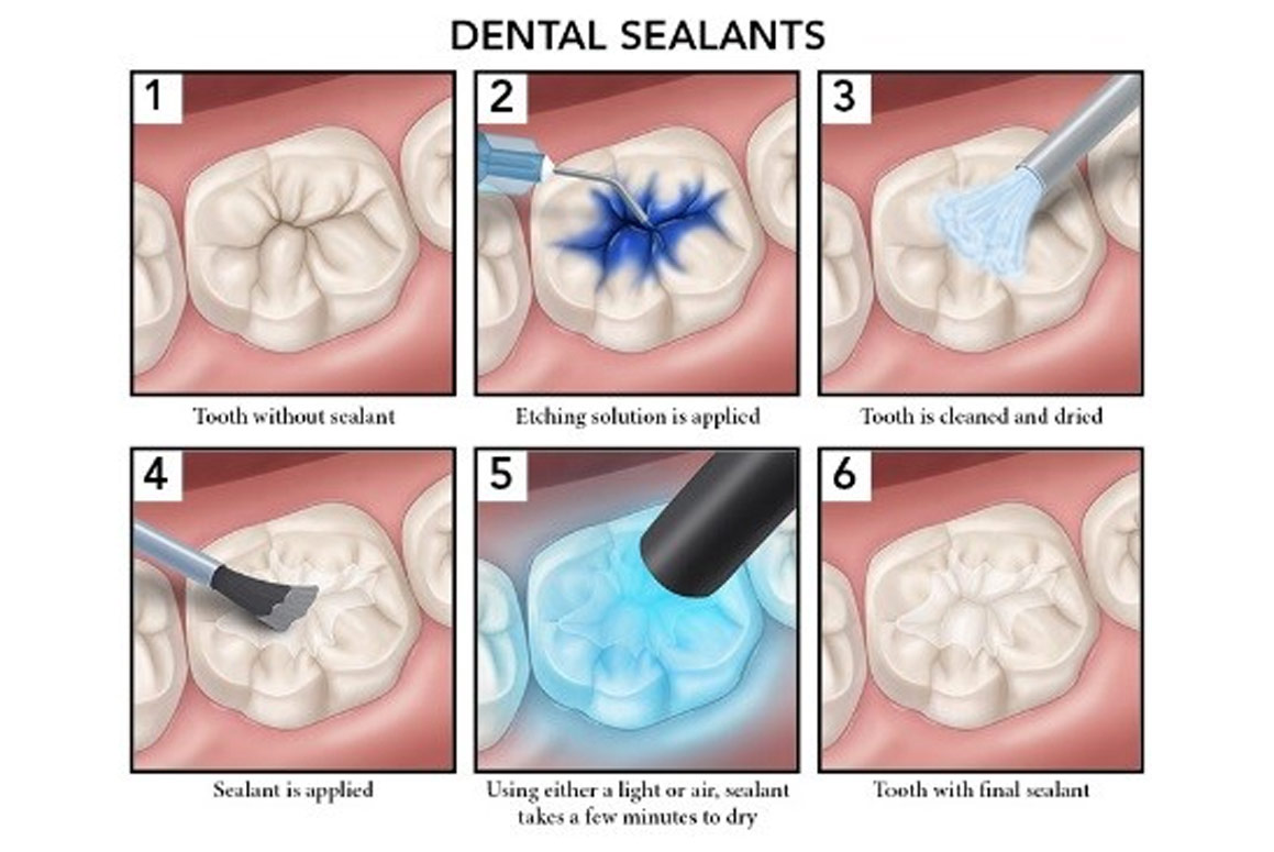 Preventative Procedures - Page Family Dental Group | Dentists in Naples ...